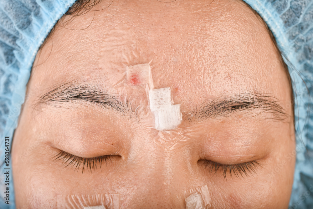 Facial skin problem, Acne disease in adult, Close up woman face with ...