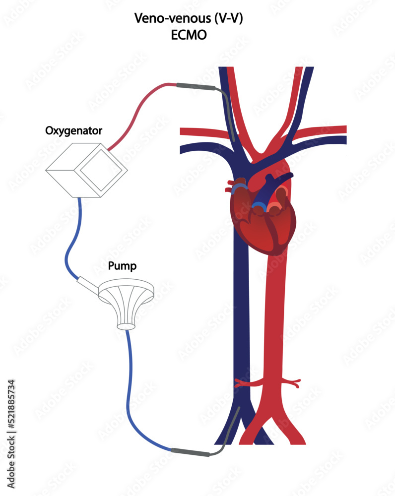 Veno-venous ECMO illustration. Blood flow illustration os a V-V ECMO ...