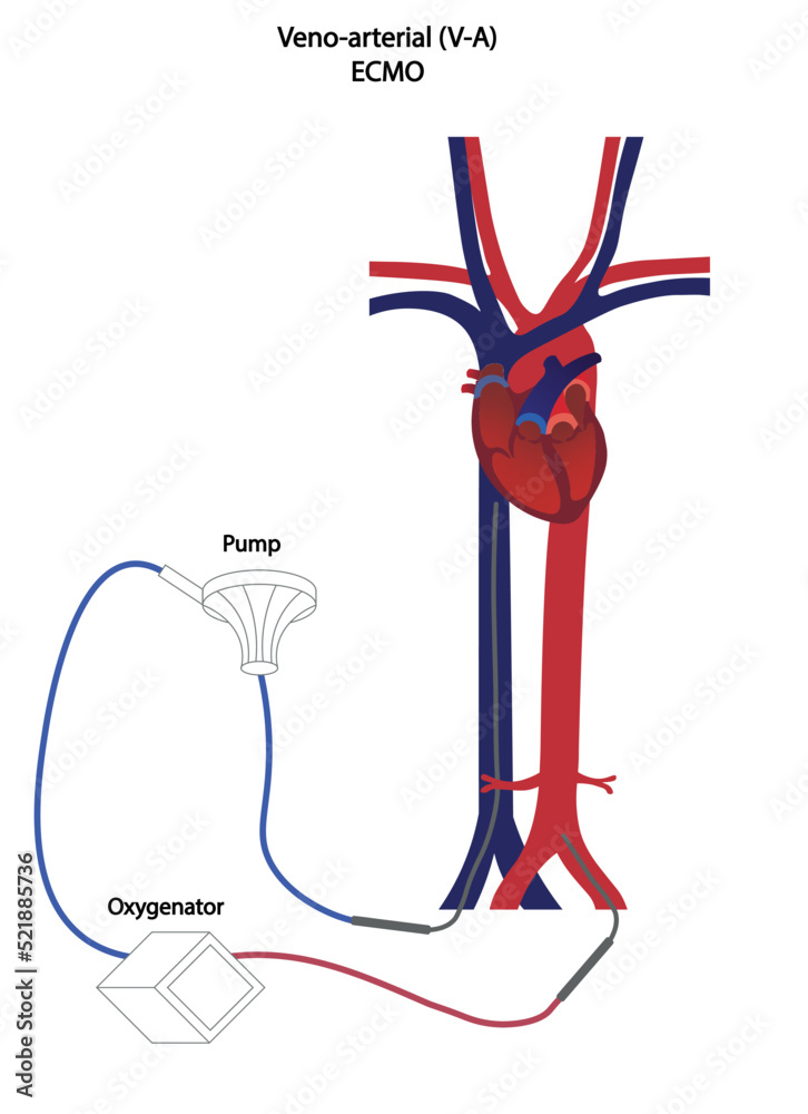 Poster Veno-arterial ECMO illustration – Wall Art | UkPosters