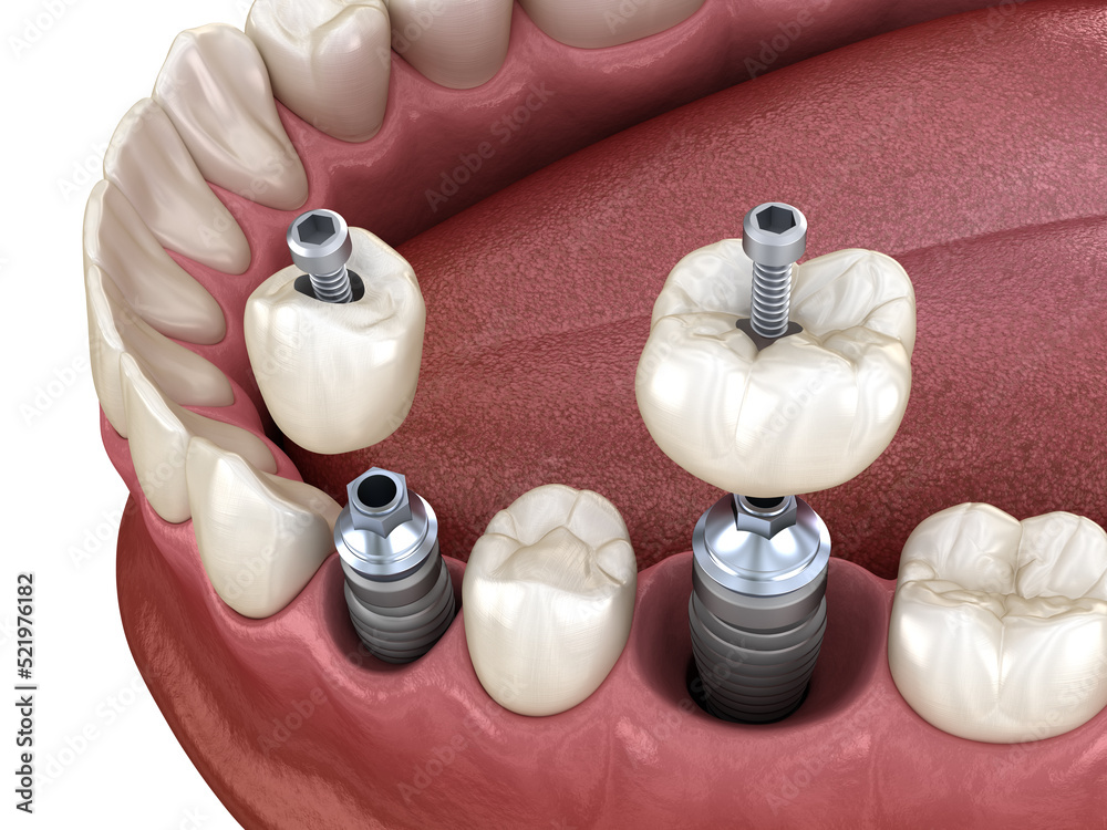 Premolar and Molar tooth crown installation over implant, screw ...
