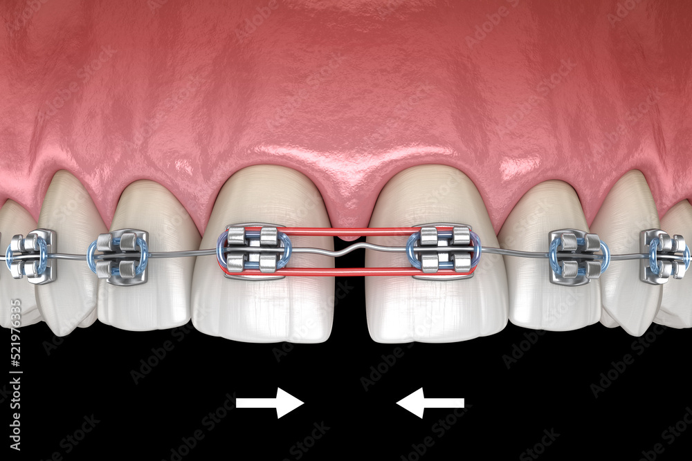 Elastics and metal braces for diastema correction. Medically accurate ...