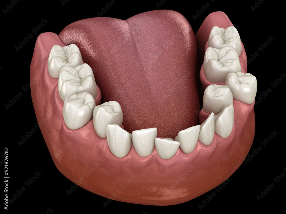 Overcrowded teeth, abnormal dental occlusion. Medically accurate tooth ...