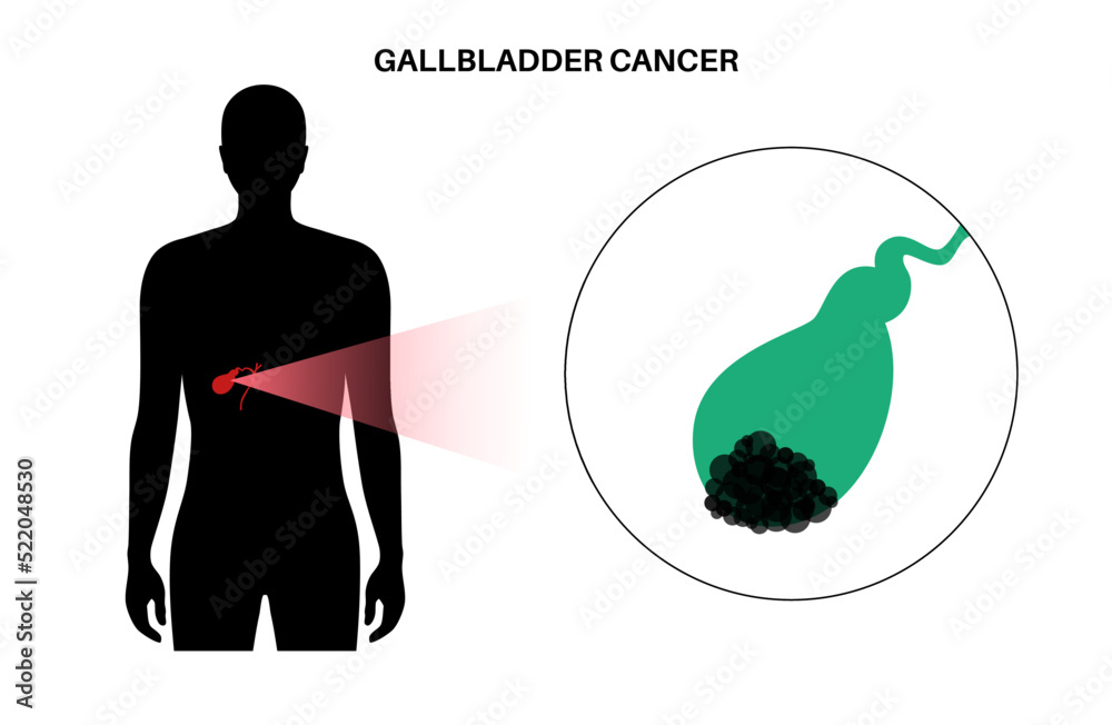gallbladder cancer anatomy Stock Vector | Adobe Stock