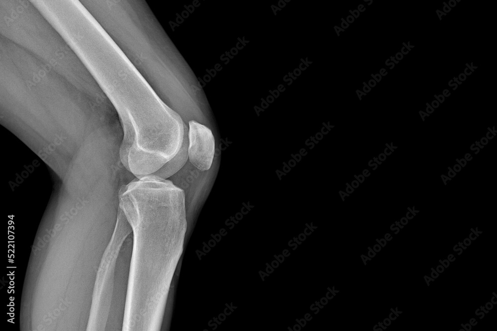 X Ray Of The Knee Joints An Image Of The Knee Bones On An X Ray Clear Picture Of The Patient