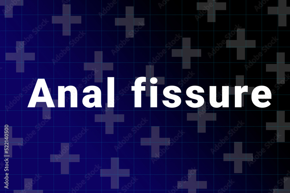 Ilustração do Stock: Anal fissure disease Illustration. Anal fissure ...