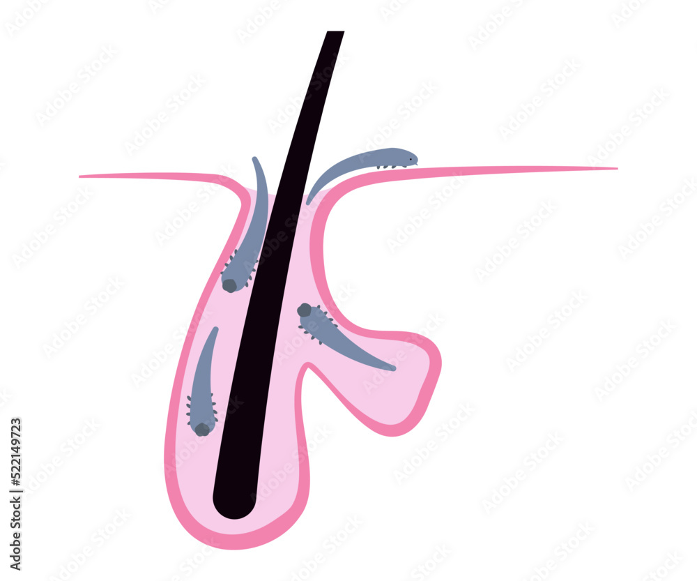 Hair follicle full of demodex mites, simple flat chart. Medical ...