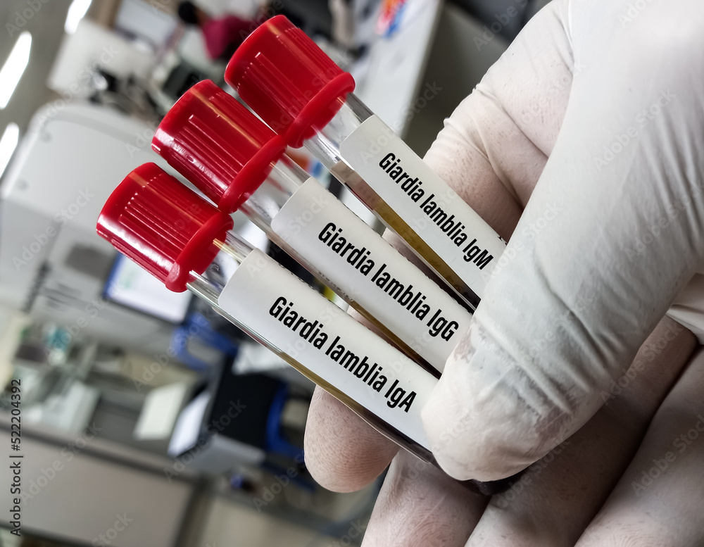 Blood sample for Giardia lamblia antibodies(IgA,IgG,IgM) test to ...