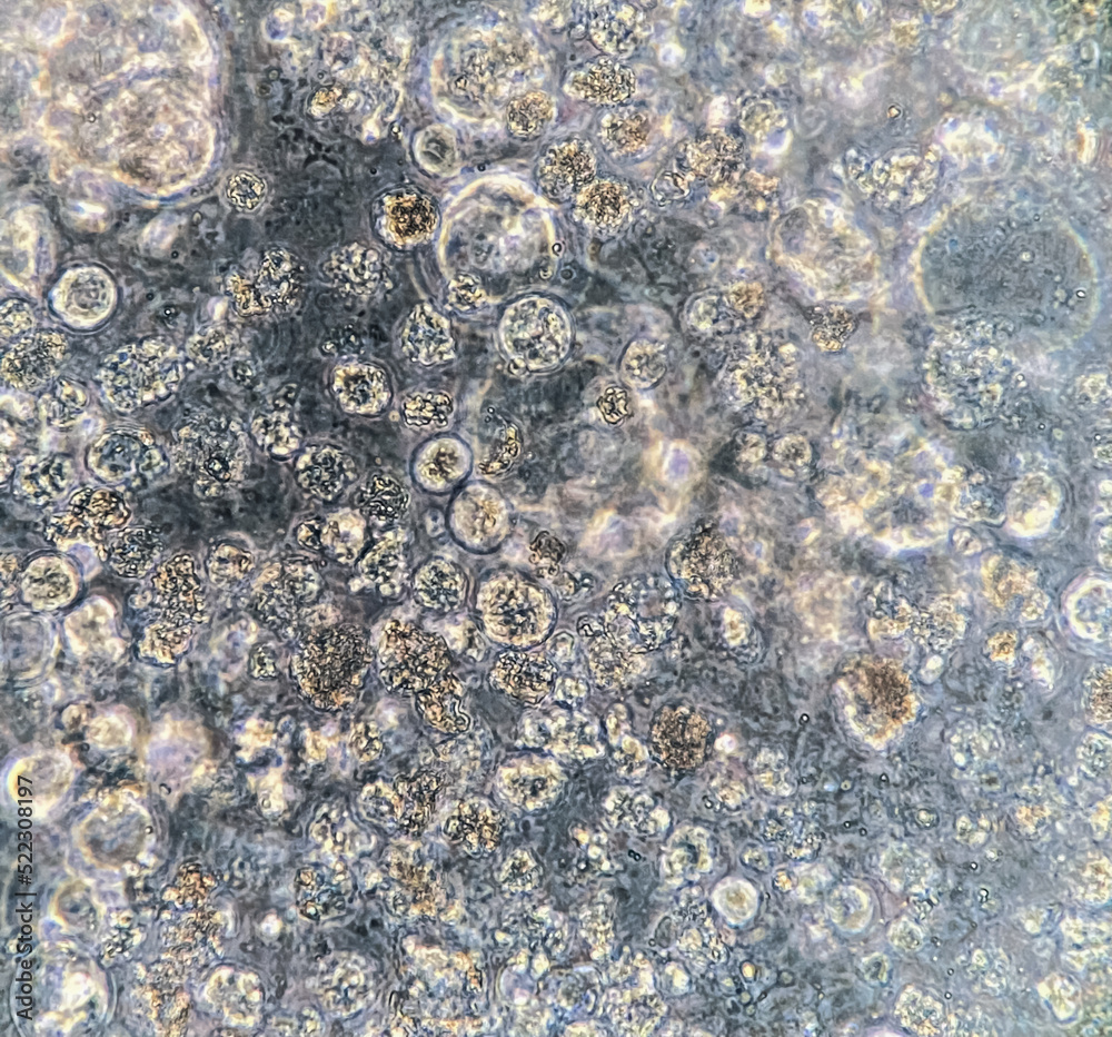 Foto de Human breast cancer cells cultured in vitro. Microscopic phase ...