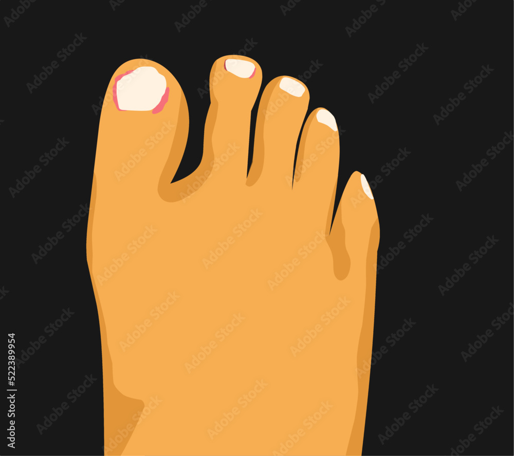 illustration of paronychia, an inflammation of the skin around the nail ...