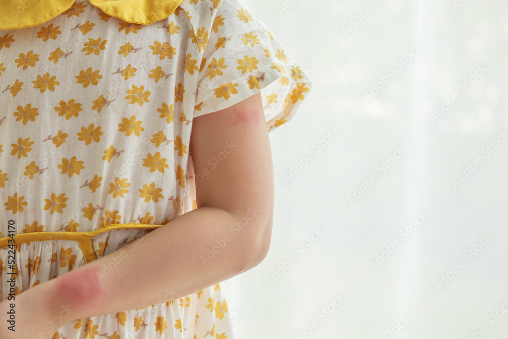 Little girl has skin rash allergy itching and scratching on her arm ...