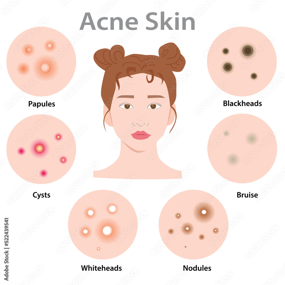 Acne face, Infographics of problem skin. Illustration skin defects ...