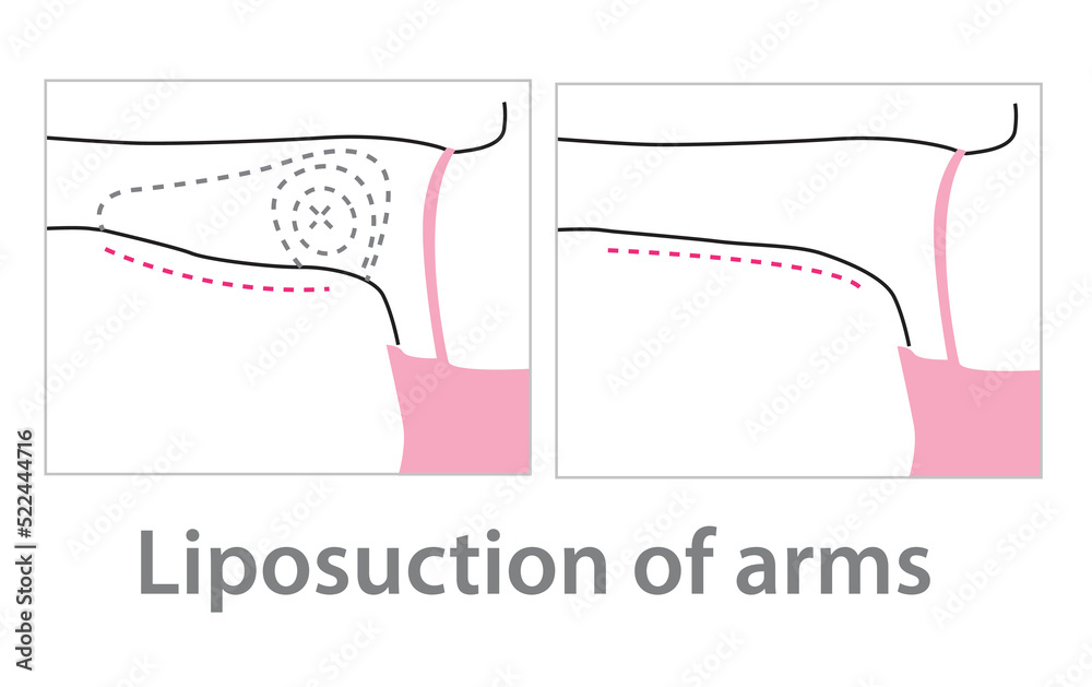 Liposuction of arms. Plastic surgery. Vector illustration of Arm with ...