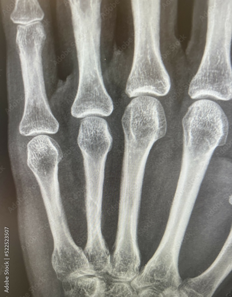 x ray of a broken bone in a human hand Stock Photo | Adobe Stock