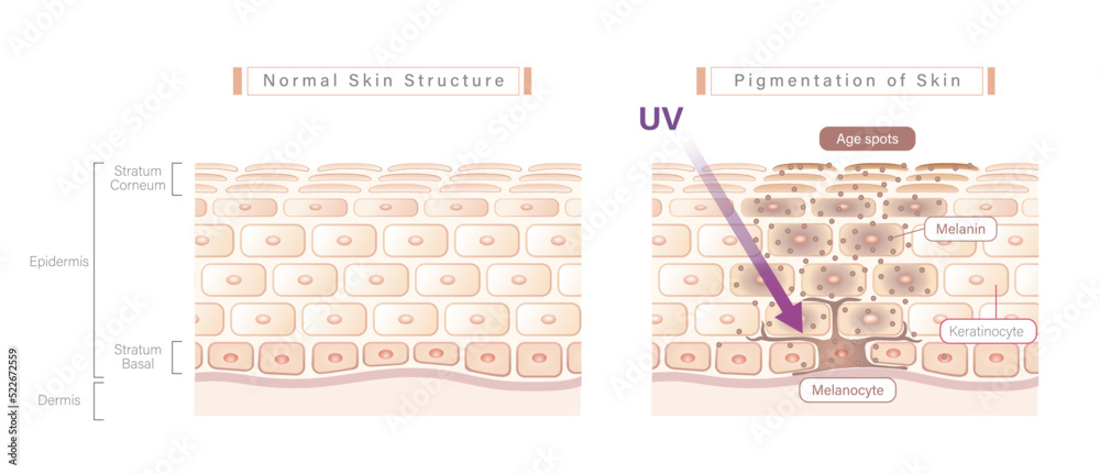Vector skin structure illustration, comparison between healthy skin and ...
