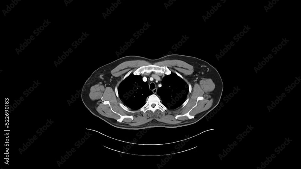 MRI Scan of the lungs. CT Scan. Axial view. Stock ビデオ | Adobe Stock