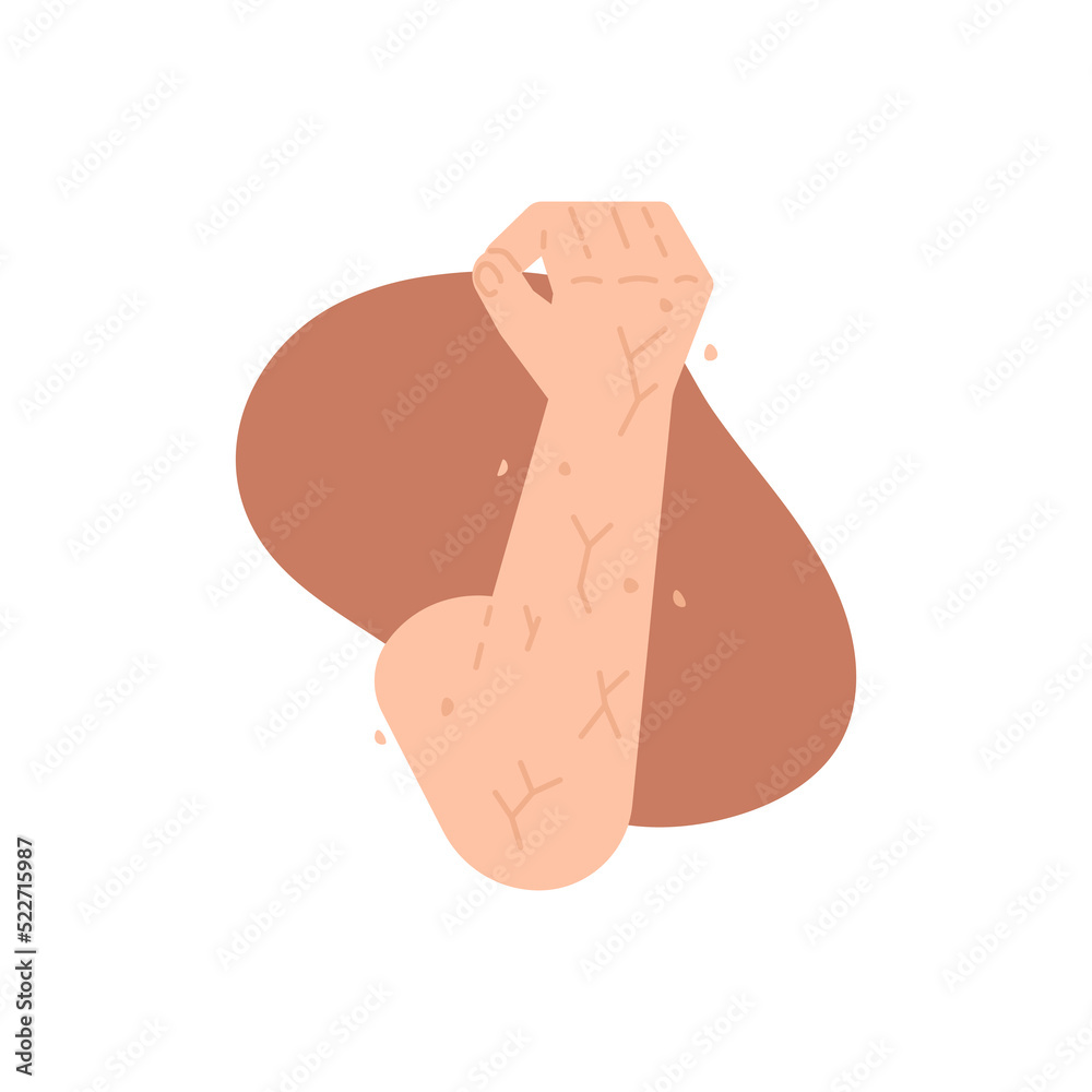 xerosis-a-dry-and-peeling-skin-condition-the-skin-on-the-hands-is