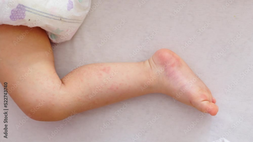 atopic eczema dermatitis sleeping baby legs, red irritation allergic ...