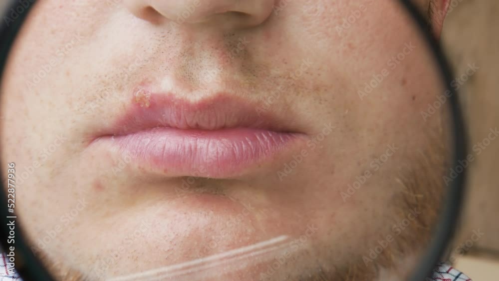 Close-up Herpes on the lip of a man through a magnifying glass, pimple ...