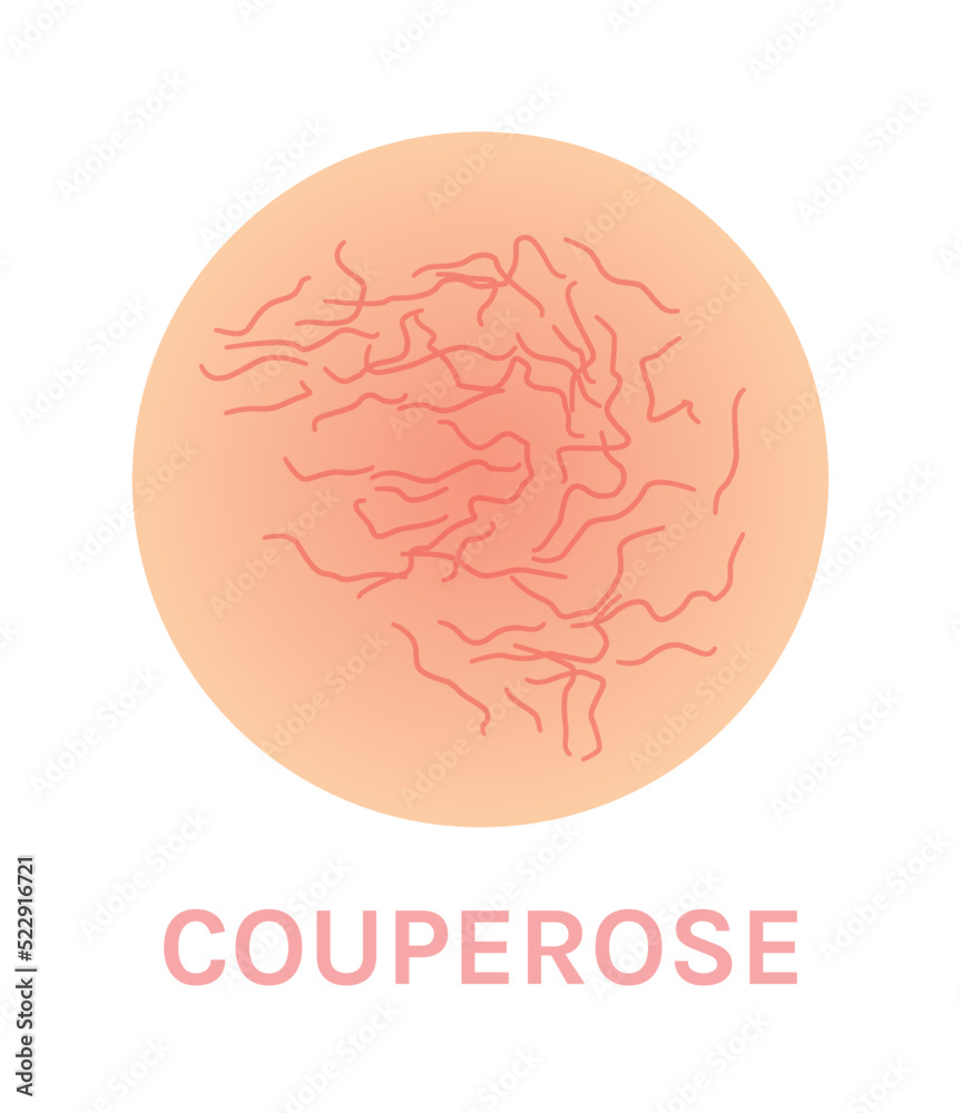 Couperose and Rosacea. Dermatological Disease. Red Capillaries on the ...