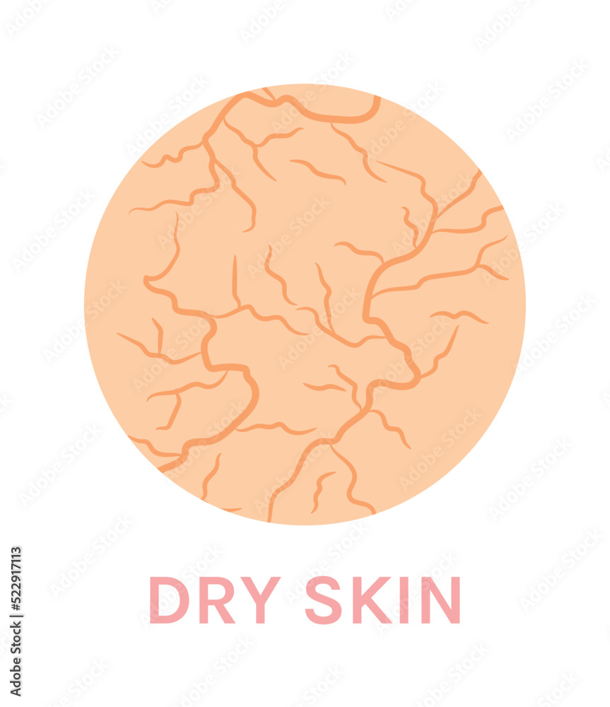 Dry Unhealthy Skin. Close-up. Facial and Body Skin Problems. Color ...