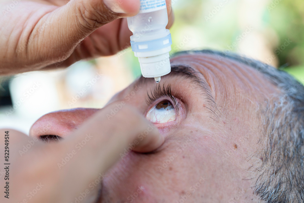 Man putting eye drops in an irritated eye. Vision, irritated eye, blood ...