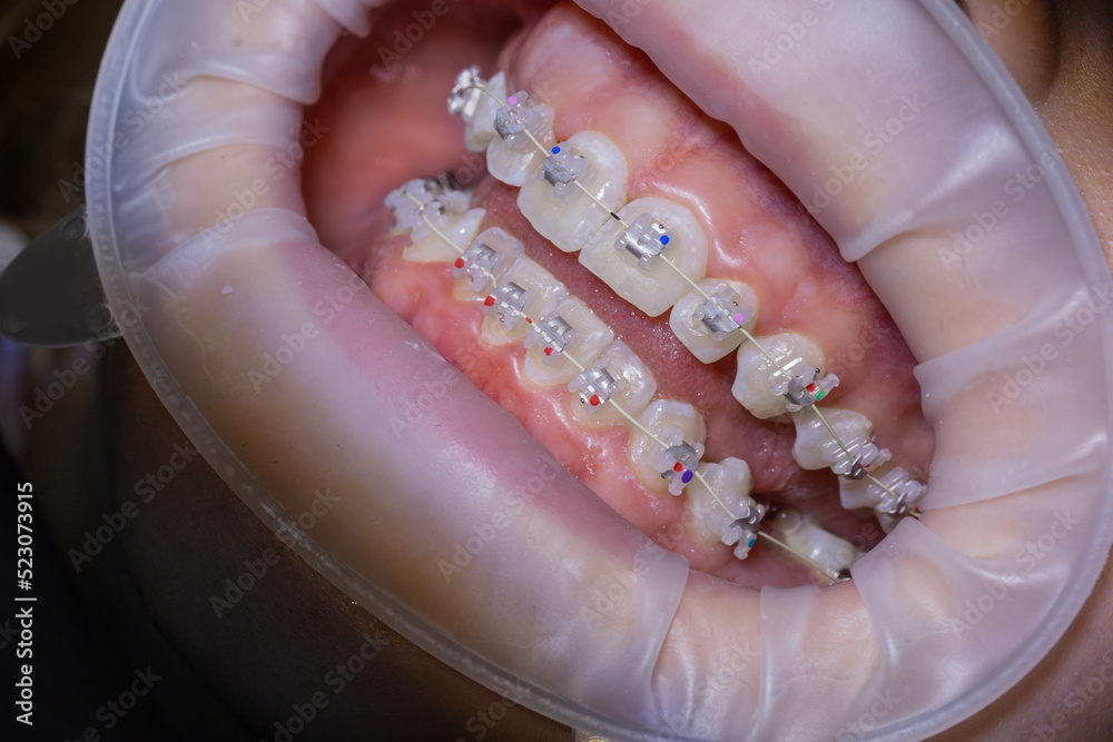 Dental procedure for installing braces close up.The procedure for the ...