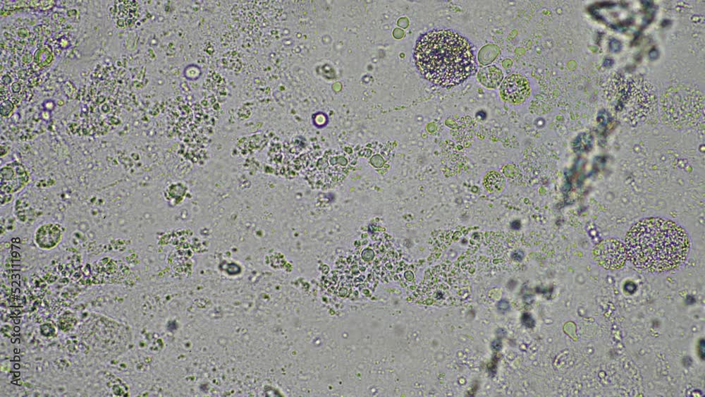 Coughing up mucus and phlegm from a chest infection from a virus and ...