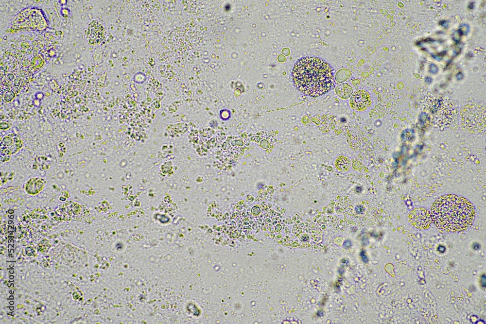 person with a virus coughing, Phlegm and mucus under the microscope ...
