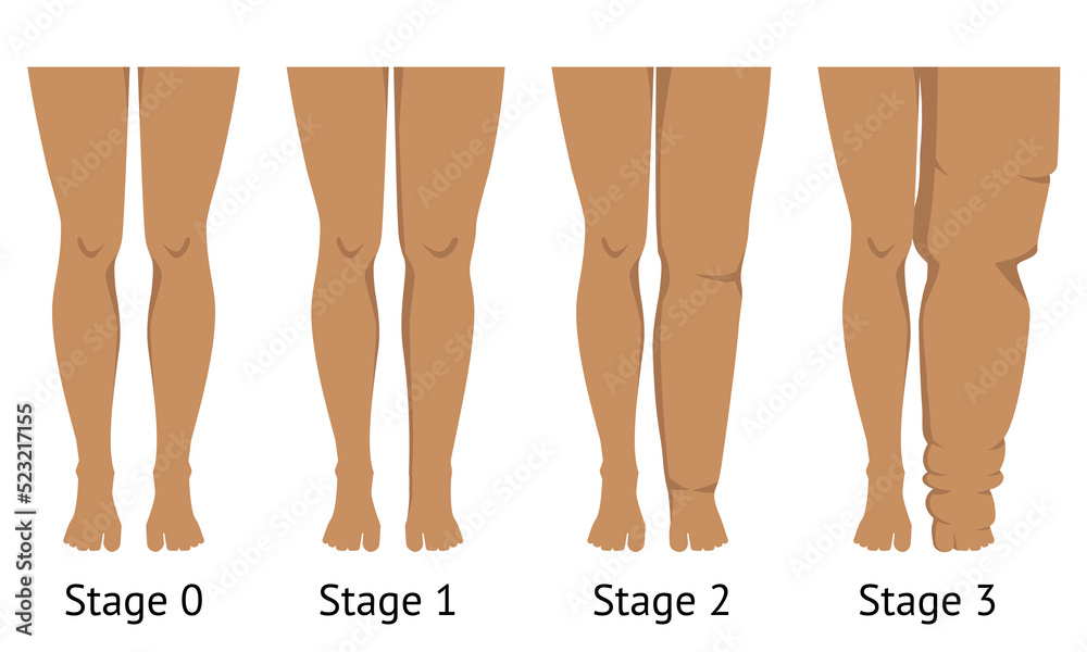 Women's legs in different stages of Lymphedema Stock Vector | Adobe Stock