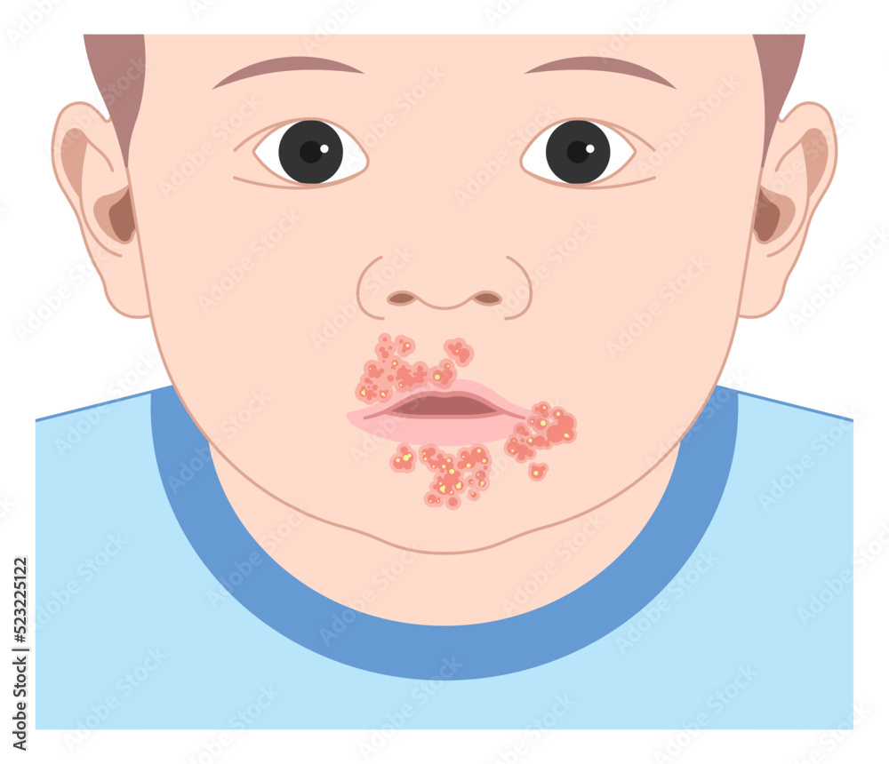 dermatitis disease baby infant impetigo oral poison ivy sepsis ...