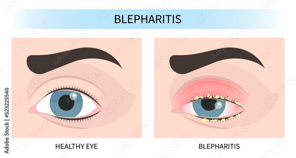 vision loss eye pain pink red surfer's blurry ulcer bacteria lens sores ...