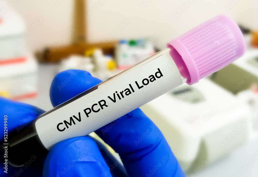 Cytomegalovirus (CMV) PCR viral load for DNA Detection and ...
