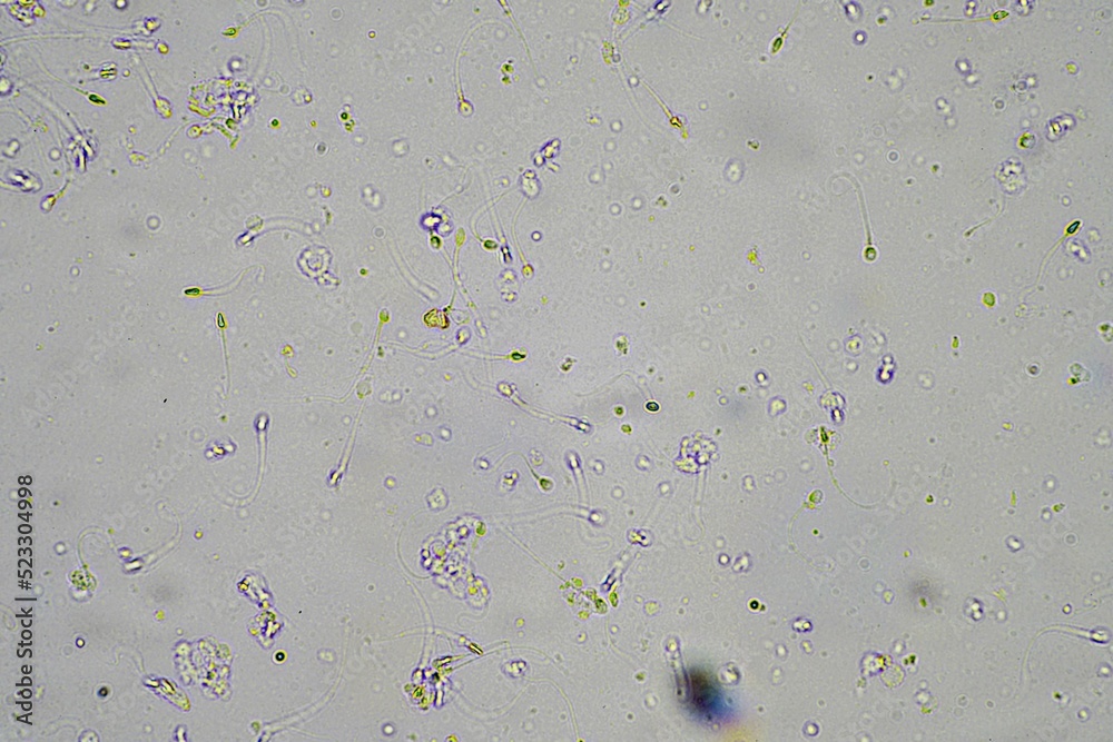 person with a virus coughing, Phlegm and mucus under the microscope ...
