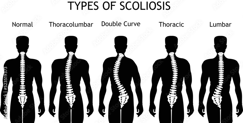 Medical poster demonstrating types of scoliosis on white background ...