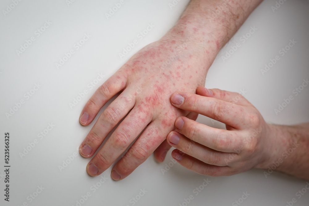 Finger scratching hands with allergic red rash. Derma disease with ...