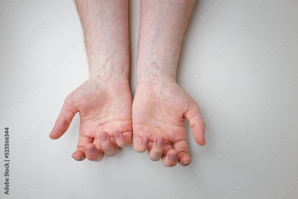 Patient showing arms and palms with red itchy painful rash. Allergic ...
