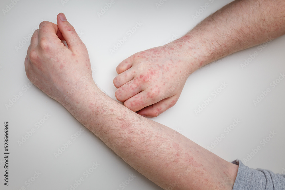 Allergy, red itchy rash on male hands and arms on white table ...