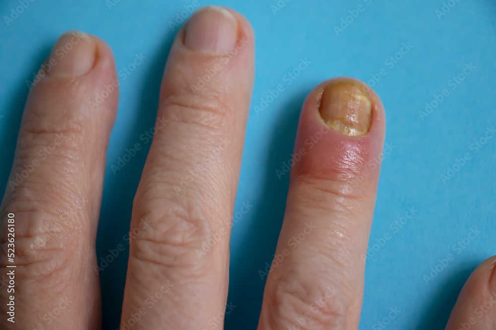 Paronychia disease of the fingernail Stock Photo | Adobe Stock