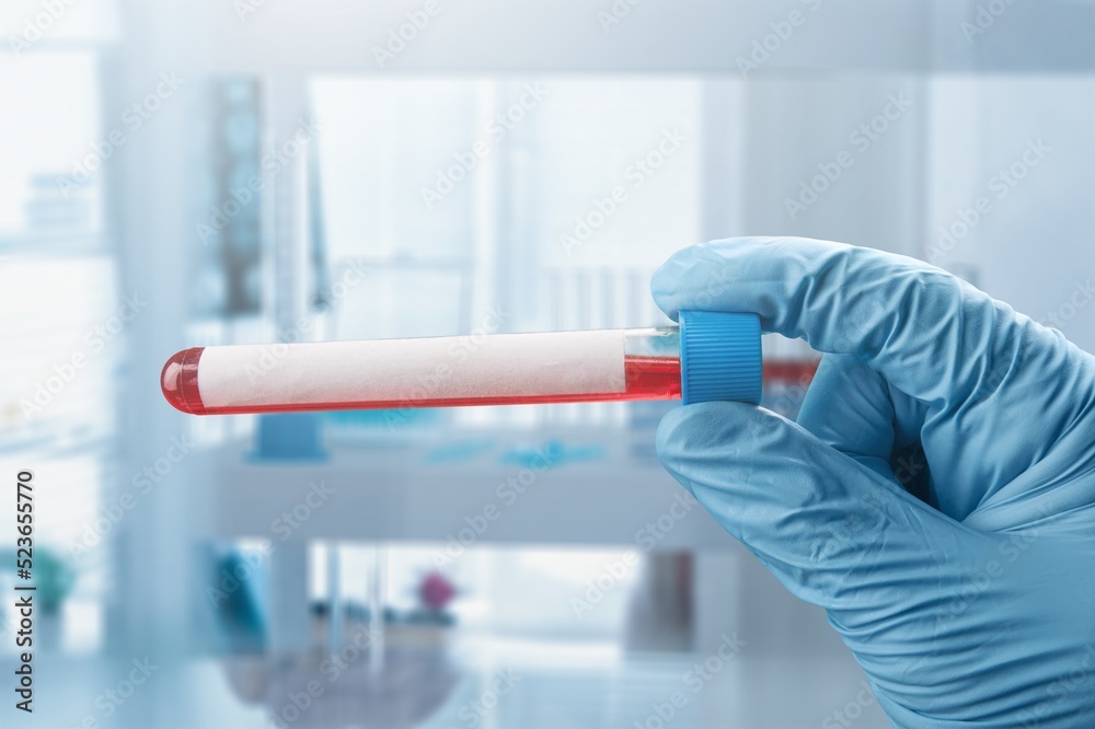 Blood sample of patient for test in laboratory. doctor with Blood tube ...