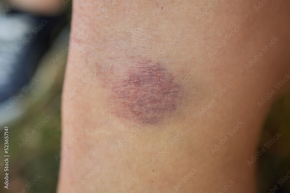 Bruise on the leg of a woman. A bruised leg. Close-up. Stock Photo ...