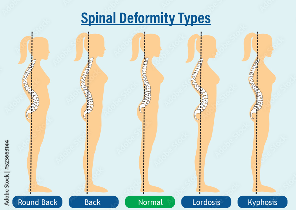 Medical poster demonstrating types of scoliosis on light blue ...