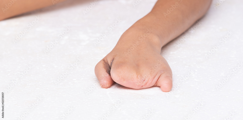 Foto de Disabled person hand without fingers since childhood brith, no ...