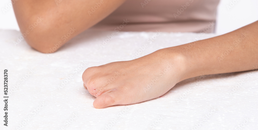 Disabled person hand without fingers since childhood brith, no thumb ...