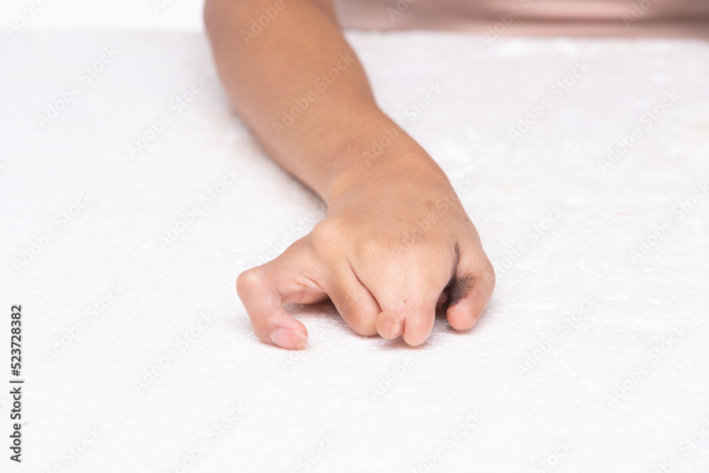 Disabled person hand without fingers since childhood brith, no thumb ...