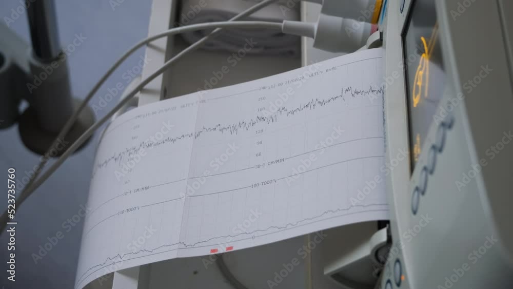 Print of cardiogram report of baby before birth. Checking fetal heart ...