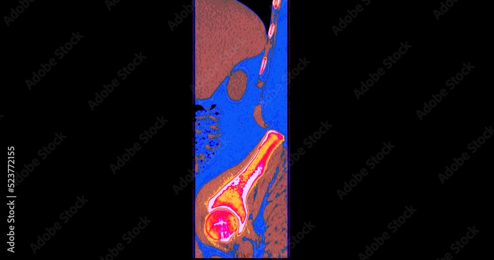 CT Scan of lumbar spine for diagnosis alck back pain diseases Stock ...