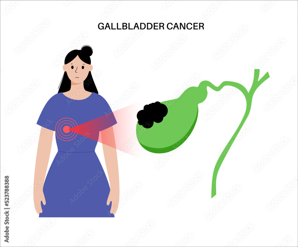 gallbladder cancer anatomy Stock Vector | Adobe Stock