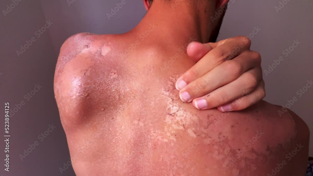 Peel back and shoulder skin from sunburn effect on young man body from ...