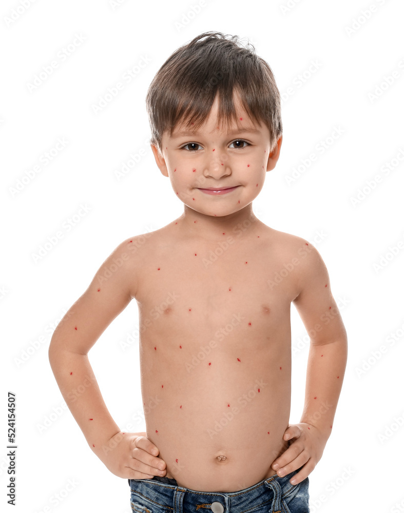 Little boy with chickenpox on white background. Varicella zoster virus ...