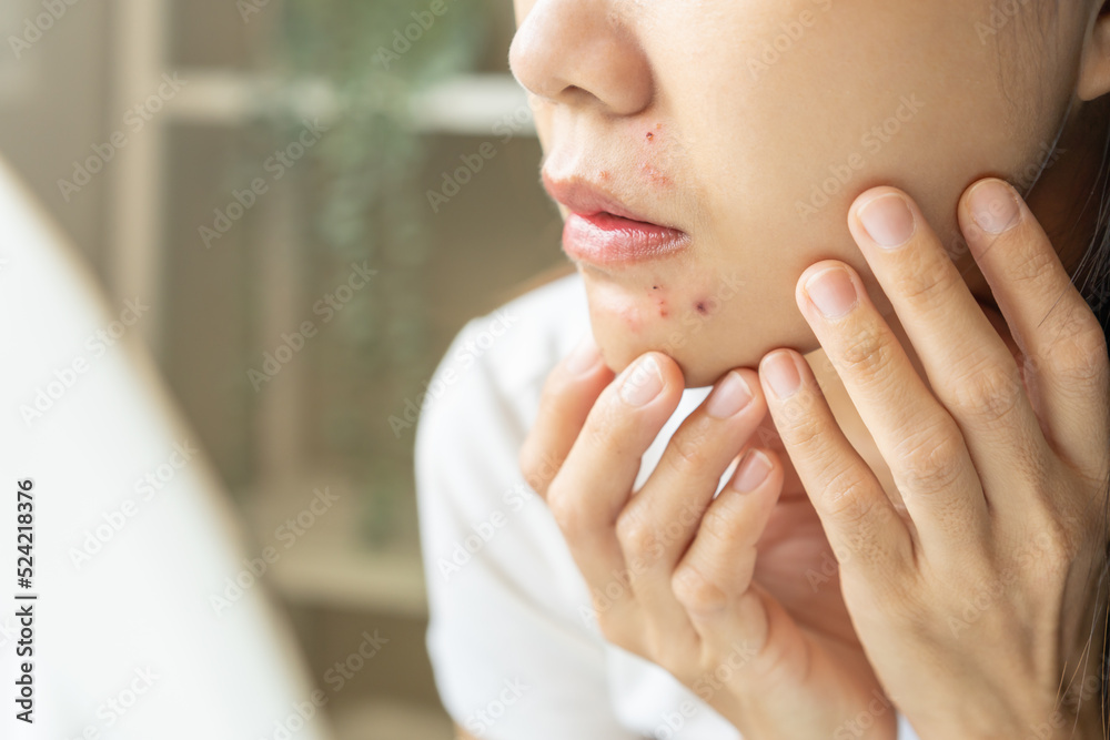 Expression worry asian young woman hand touching pustule around the ...